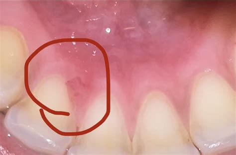 Bruised Gums Causes And Treatment Of Bruised Gums — Brightwork