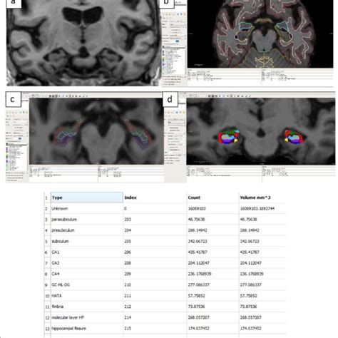 Subiculum And Ca1 Subfields Mean Volumetric Measurements In Patients