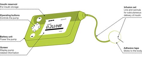 Racgp Continuous Glucose Monitoring And Pumps