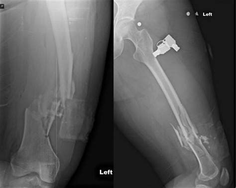 Comminuted Fracture In The Left Distal Femur Download Scientific Diagram