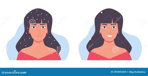 Sad Woman With Flake On Head And Shoulders And Joyful Woman Without Dandruff Dry Scalp Problem