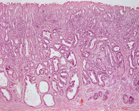 109 早期胃癌（管状腺癌 Iia） （消化器系2 その6） 滋賀医科大学 病理学講座 人体病理学部門