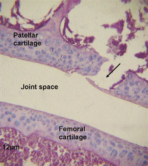 Photomicrograph Showing Patellar Cartilage And Joint Space Arrow