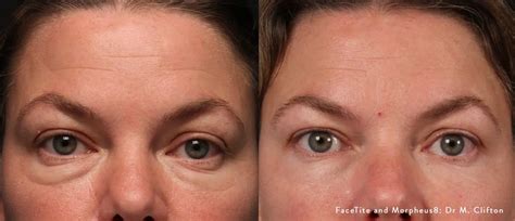 Morpheus8 Before And After Results Neck Under Eyes Morpheus 8 Toronto