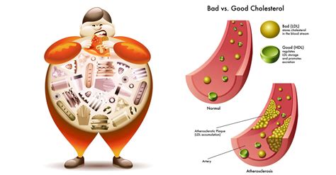 Total Cholesterol Overview Medical Laboratories
