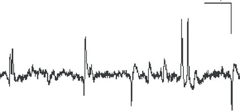 Positive Sharp Wave And Fibrillation Potentials Download Scientific