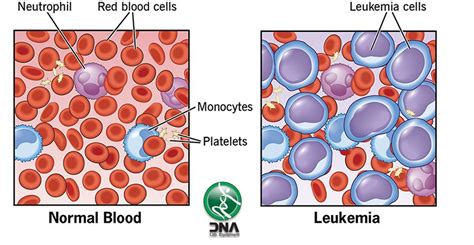 Cedar Holding On Linkedin Leukemia Bruising Fatigue Fever Lymphomas Tumors