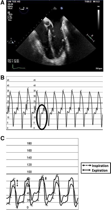 Transesophageal Echocardiogram And Cardiac Catheterization Findings A Download Scientific