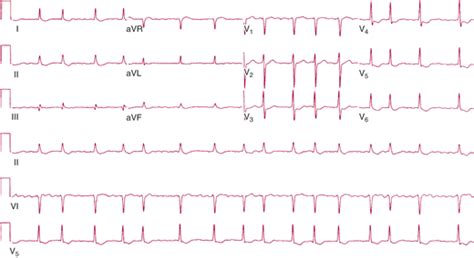 Atrial Fibrillation Thoracic Key