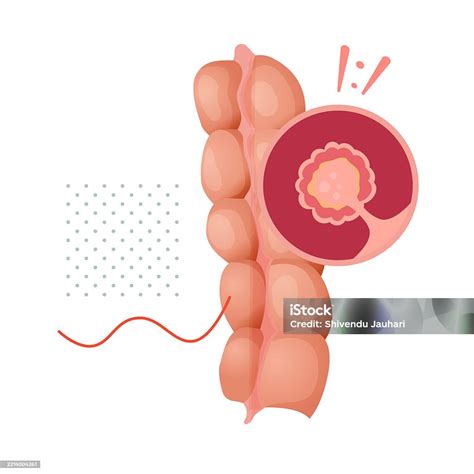Colon Polyps An Abnormal Tissue Growths Stock Illustrations Stock