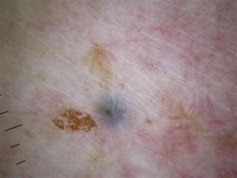 Annular Lesion On The Breast Ppt