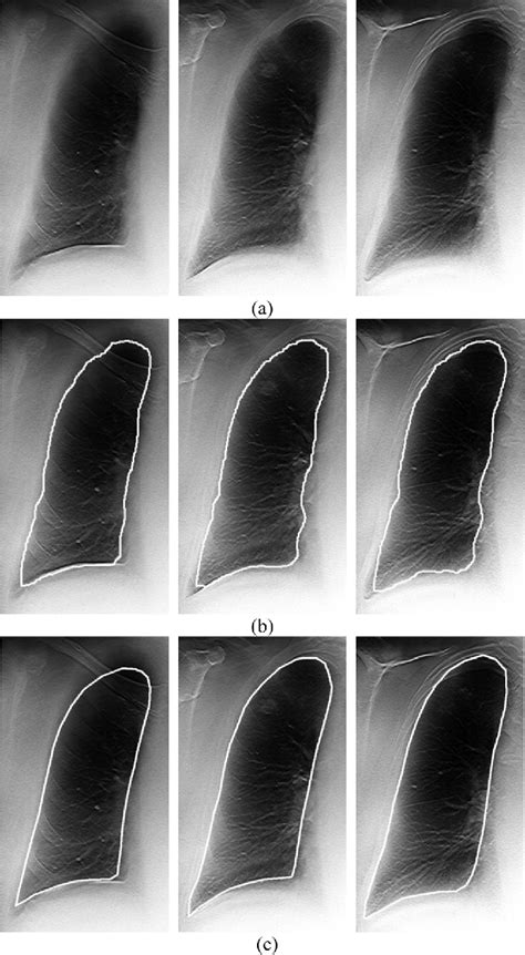 figure 1 from automated lung segmentation in digital chest