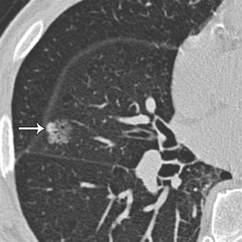 Updated Fleischner Society Guidelines For Managing Incidental Pulmonary