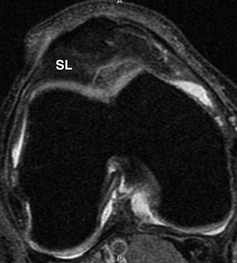 Superolateral Hoffas Fat Pad Edema Association With Patellofemoral