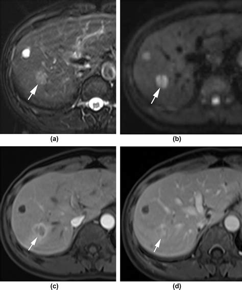 “very Early” Intrahepatic Cholangiocarcinoma ≤ 2 0 Cm Mri