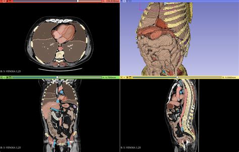Totalsegmentator Results Computed In Fast Mode Are Rough Support 3d Slicer Community