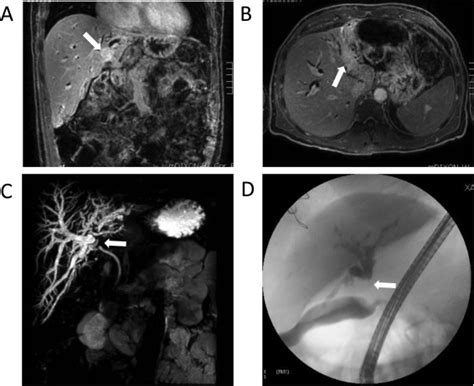 Clinical Diagnosis And Management Of Perihilar Cholangiocarcinoma Pmc