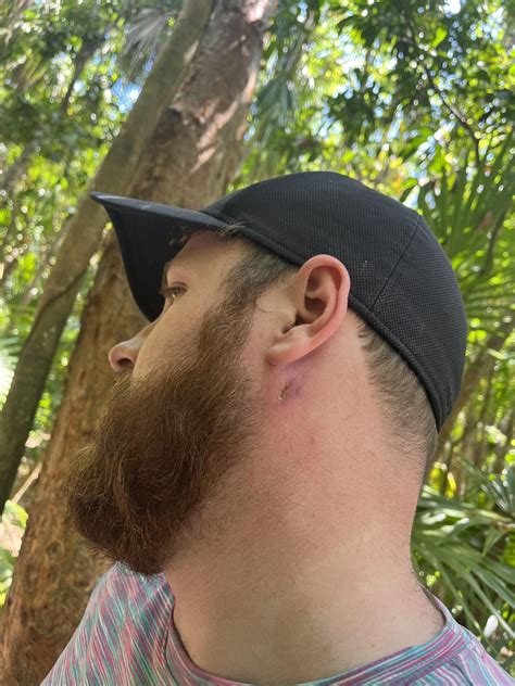 Stages Of Abcess Due To Blocked Salivary Gland Sliced It Open Myself