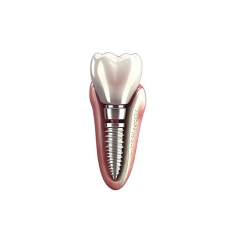 Implante Dental Implante Dentário Vetor Premium