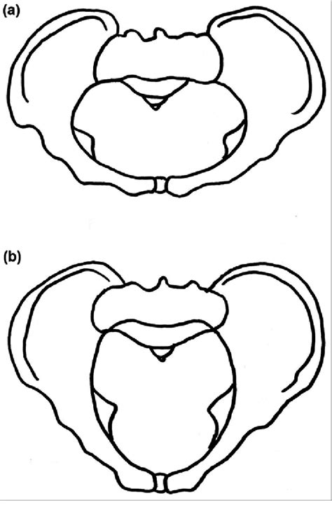 Schematic Of A Platypelloid And B Anthropoid Pelvis Types