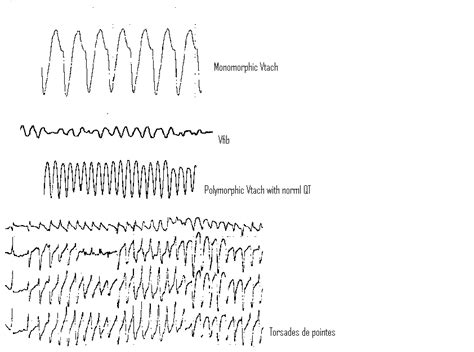 Difference Between Monomorphic And Polymorphic Ventricular Tachycardia