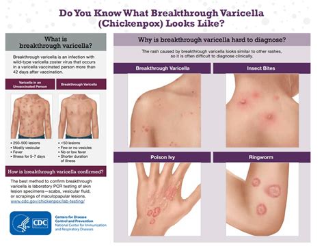 Breakthrough Varicella Fact Sheet Chickenpox Varicella Cdc Breakthrough Varicella Fact Sheet Chickenpox Varicella Cdc