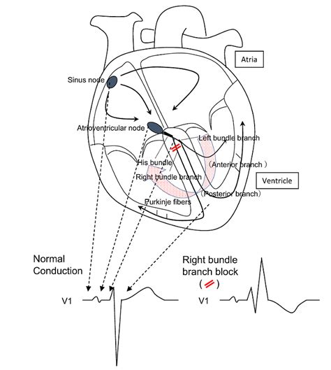 우각차단 Rbbb Right Bundle Branch Block 원인 증상 심전도 Ekg 특징 예후 치료 심장 자극전도계 이상 네이버 블로그