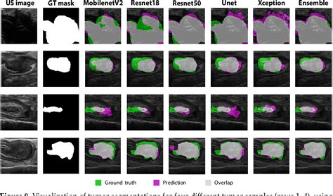 Figure 8 From Tumor Segmentation In Colorectal Ultrasound Images Using An Ensemble Transfer
