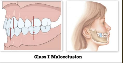 Ids Occlusion Quiz Flashcards Quizlet