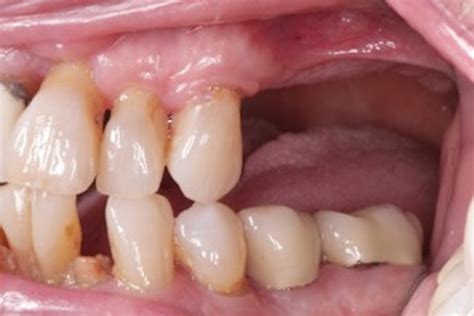 Removing A Retained Root Technique And Procedure