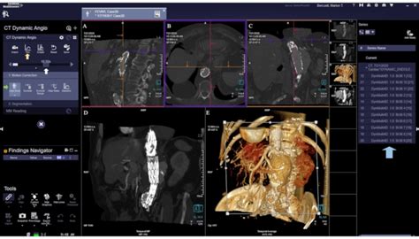 Time Resolved Dynamic Computed Tomography Angiography For
