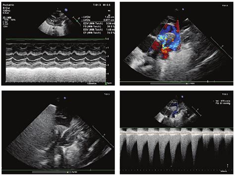 Echocardiography Showed Left Ventricular Dilatation And Hypertrophy Download Scientific Diagram