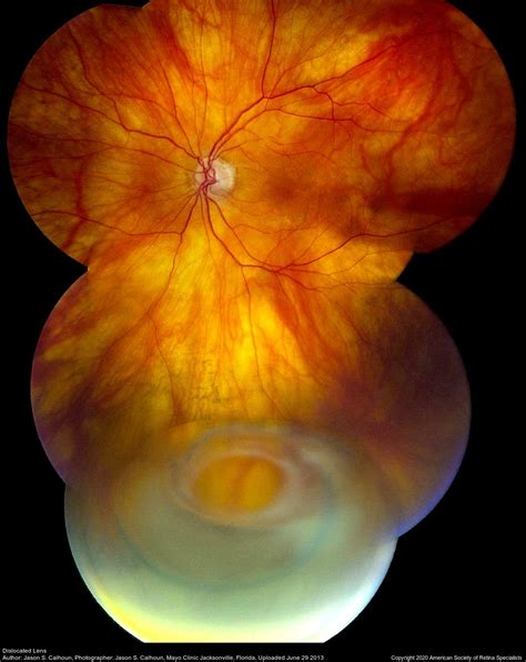 Dislocated Intraocular Lens Annan Retina Eye Center In Houston Texas