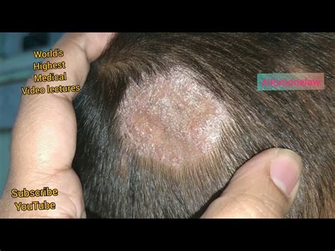 Fungal Infection Of The Scalp Tinea Capitis Causes Risk 41 Off