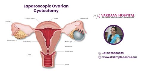 Laparoscopic Ovarian Cystectomy In Goregaon West Mumbai
