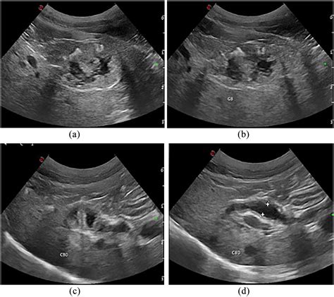 Cystic Duct Cat