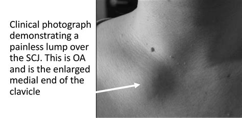 Enlarged Clavicle Joint What Is This Swelling Above My Collar Bone