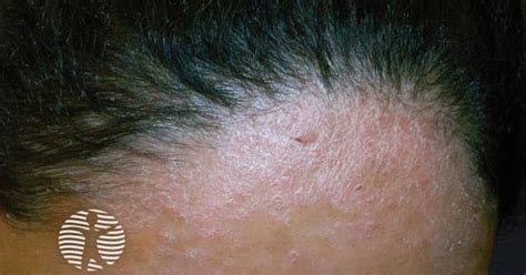 Psoriasis Of The Scalp Image