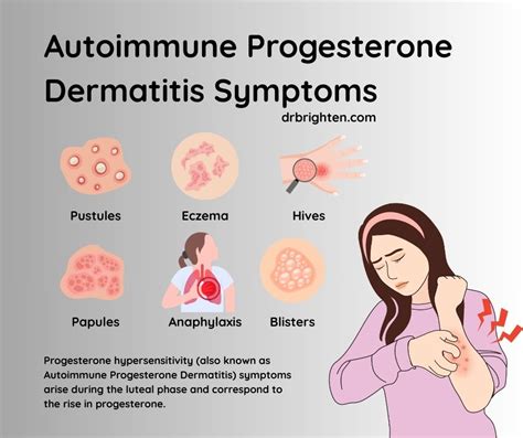 Autoimmune Progesterone Dermatitis Causes And Foods To Avoid