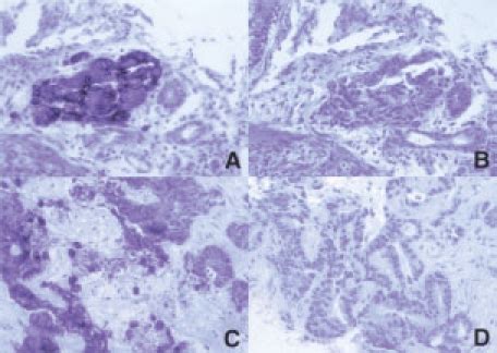Ck A And Ck B Immunostaining Of Primary Colon Adenocarcinoma Download Scientific