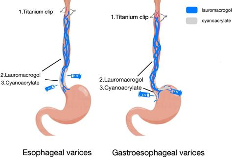 Endoscopic Injection Sclerotherapy Assisted By Cyanoacrylate And Clips For Gastroesophageal Varices