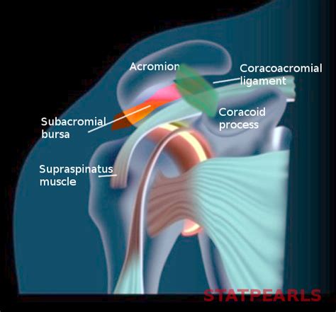 Subacromial Bursitis Md Searchlight