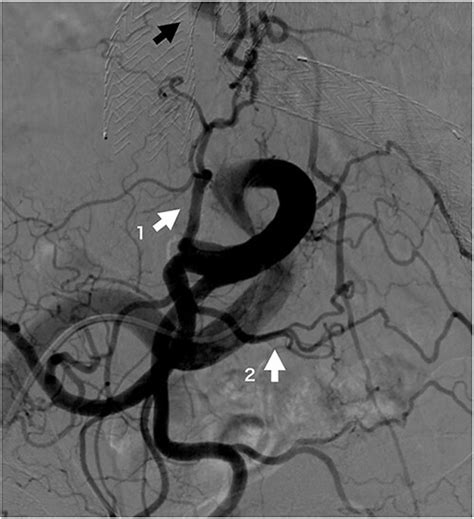 Mid Term Outcomes Of Hypogastric Artery Embolization In Endovascular