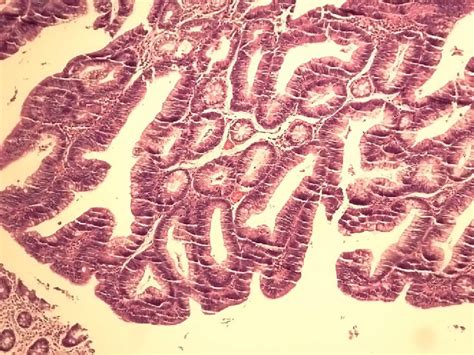 Adenomatous Polyp With Low Grade Epithelial Dysplasia And Tubular Download Scientific Diagram