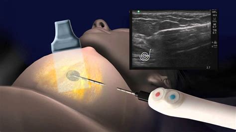 Cryoablation Procedure Youtube