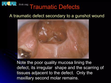 10 Etiology Of Palatal And Paranasal Sinus Defects Ppt Ear Nose