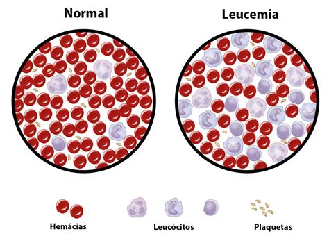 Cid Leucemia Linfoide Aguda Retoedu