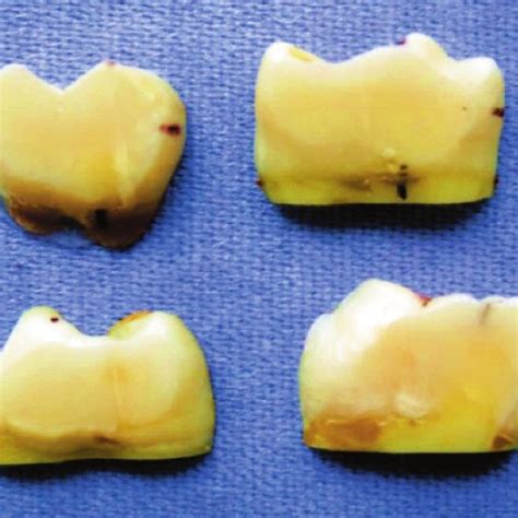 An Illustration Of The Rustogi Modification Of The Navy Plaque Index Download Scientific Diagram