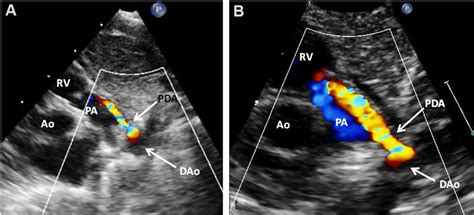 A Echo Doppler Study In A Modified High Parasternal Short Axis Download Scientific Diagram