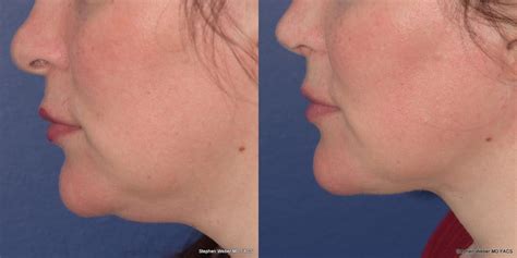 Patient 268623 Buccal Fat Removal Before And After Photos Weber